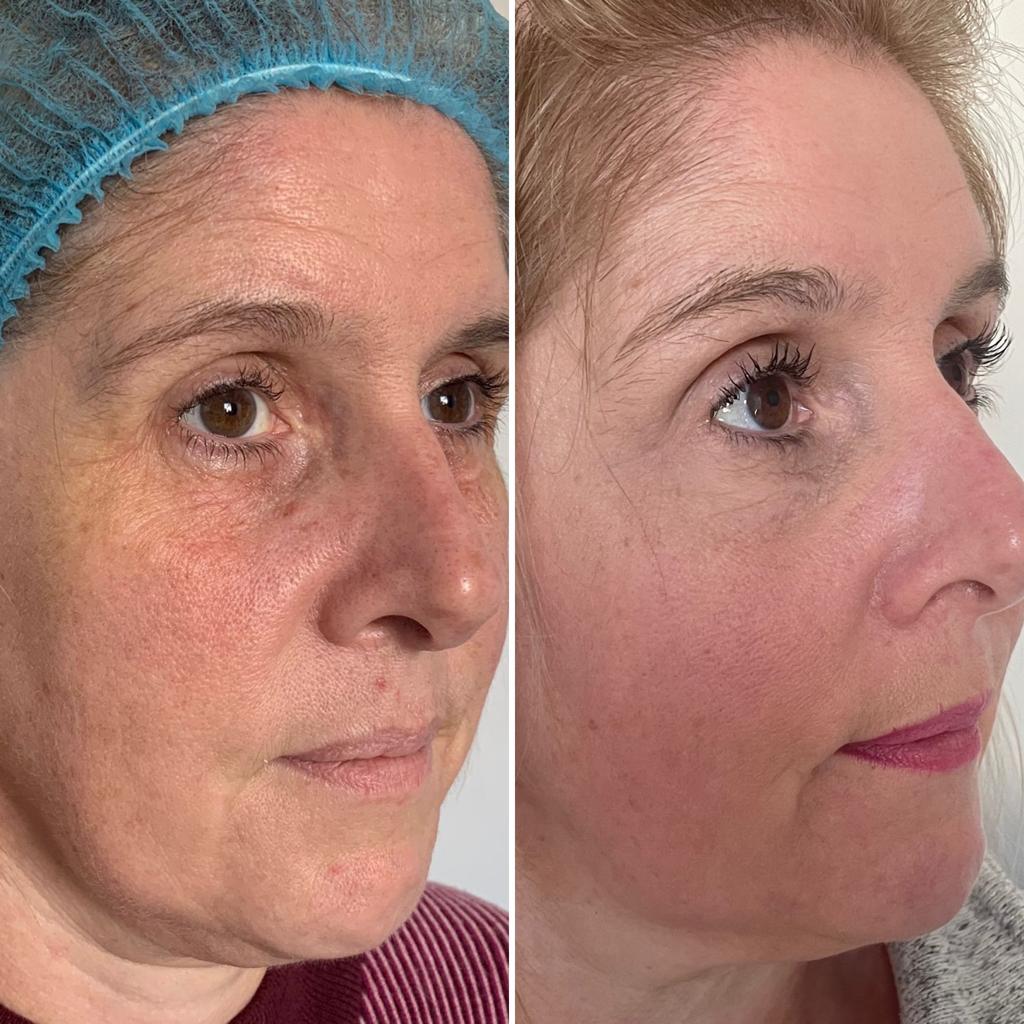 Tixel Medical Skin Resurfacing Cheltenham, Gloucestershire