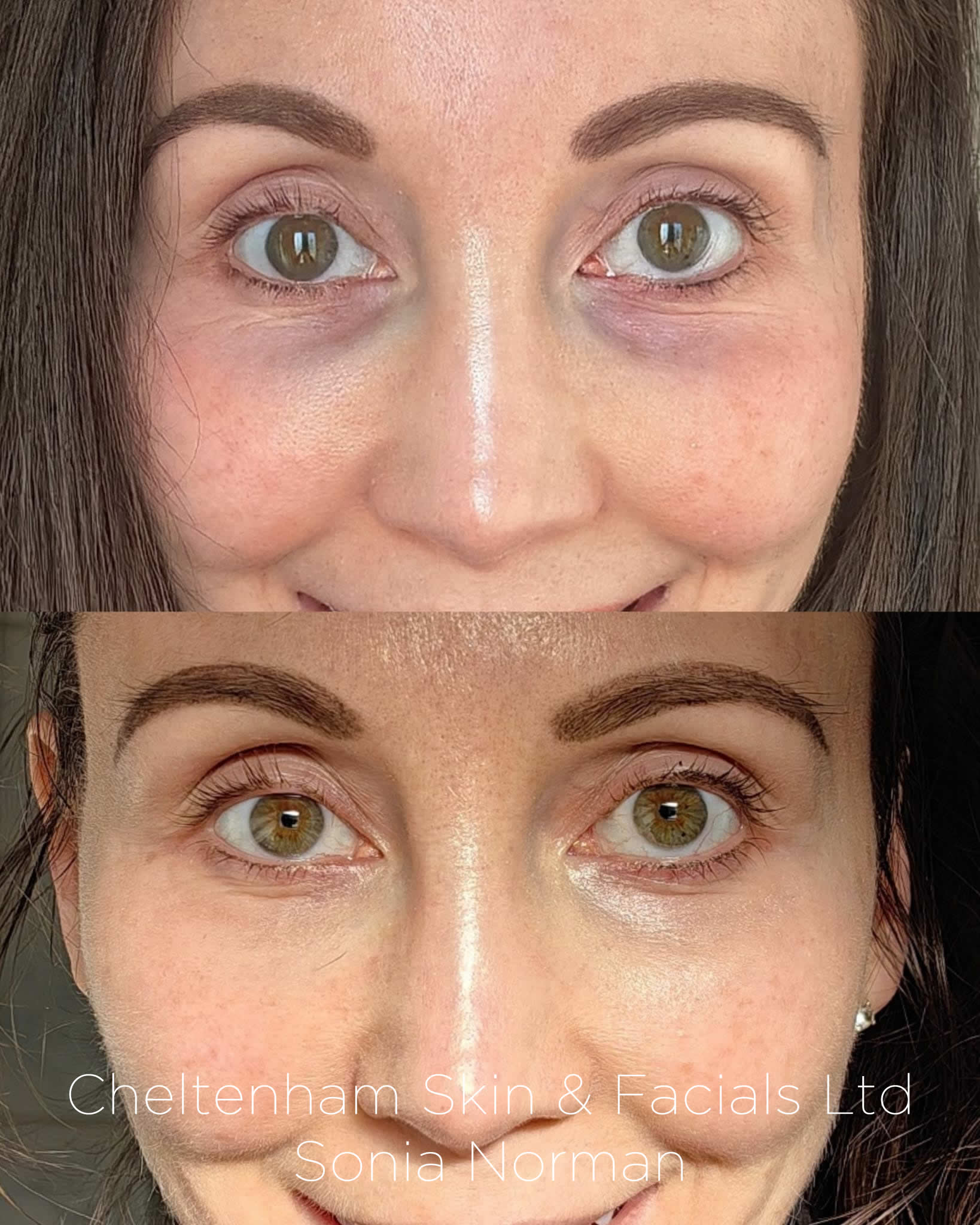 Tixel Eyes in Cheltenham: Rejuvenation, Wrinkles, Dark Circles & Dry Eye